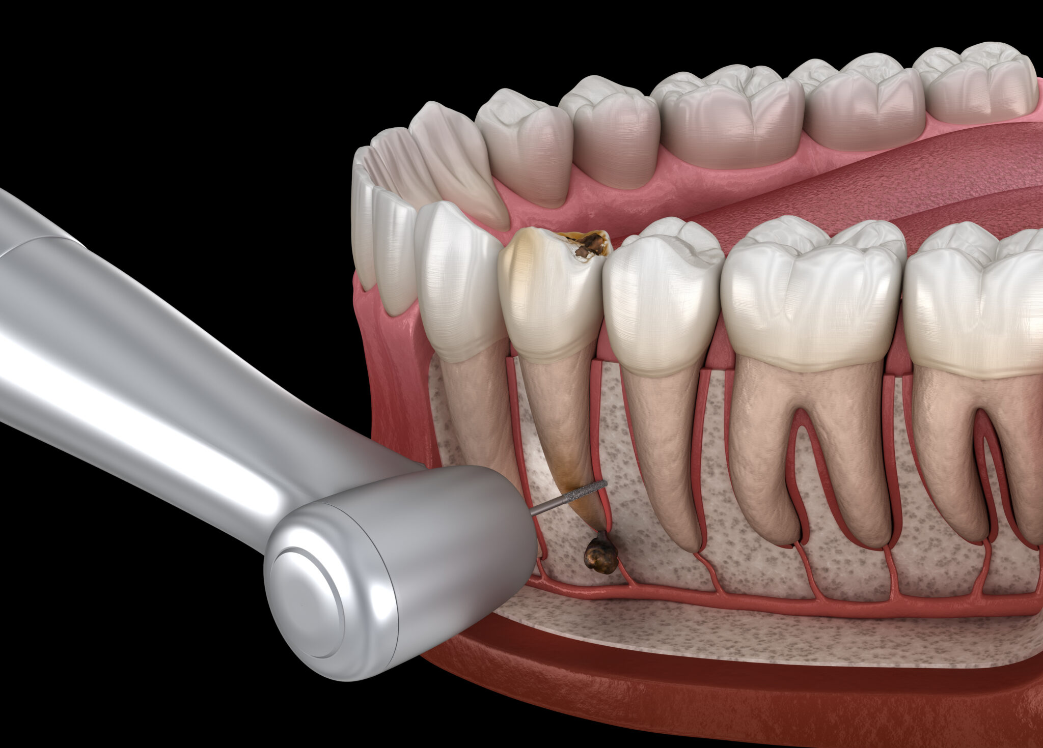 When A Tooth Needs Root Canal Surgery | El Paso, TX