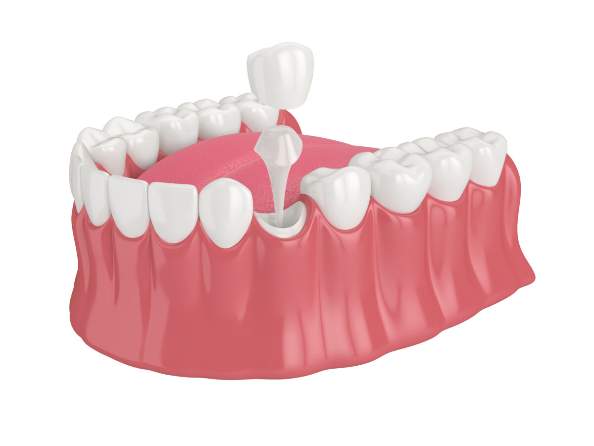 Securing Your Root Canal With Post And Core | El Paso, TX