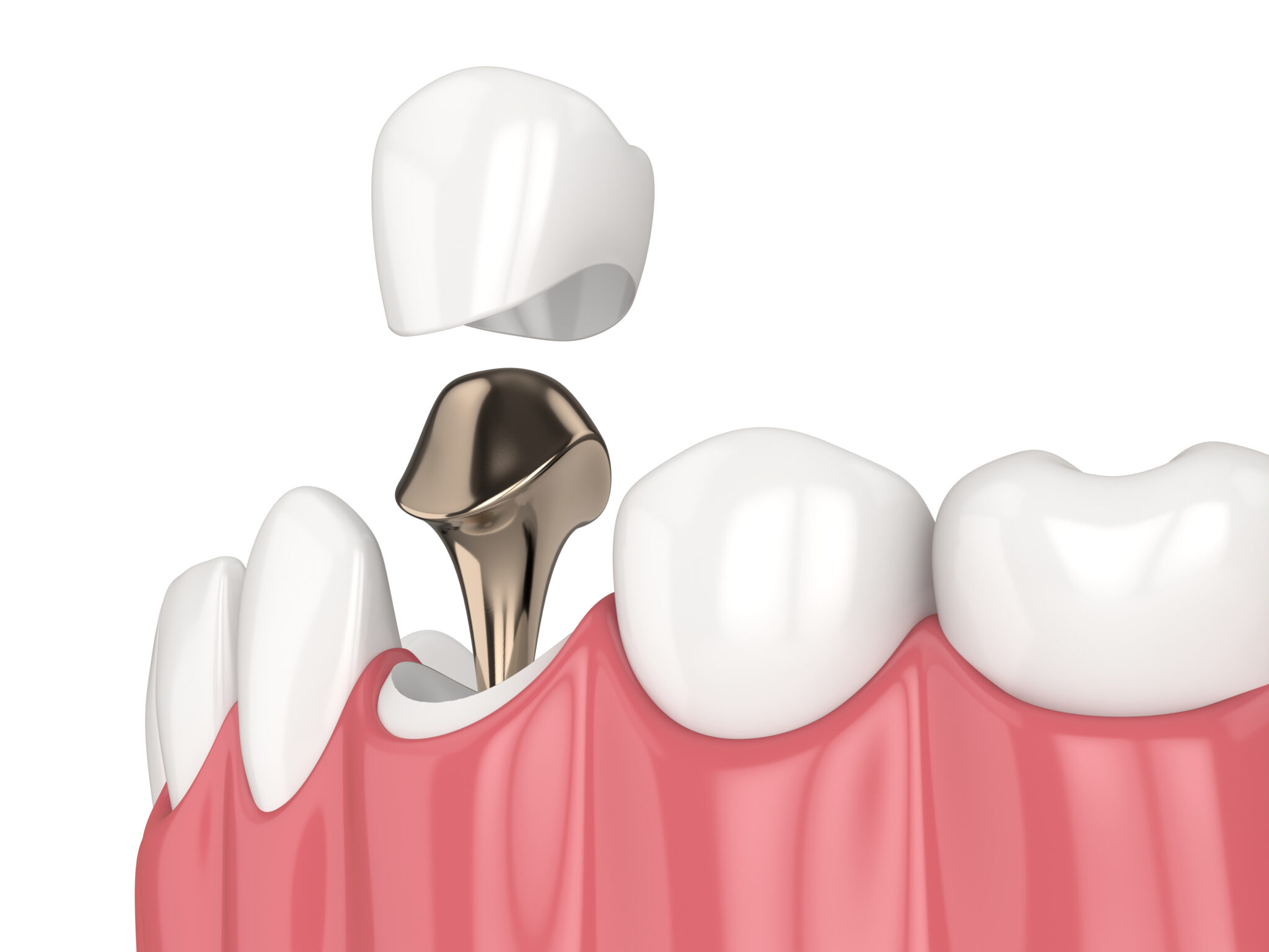 Restoring Your Smile With A Post And Core | El Paso, TX