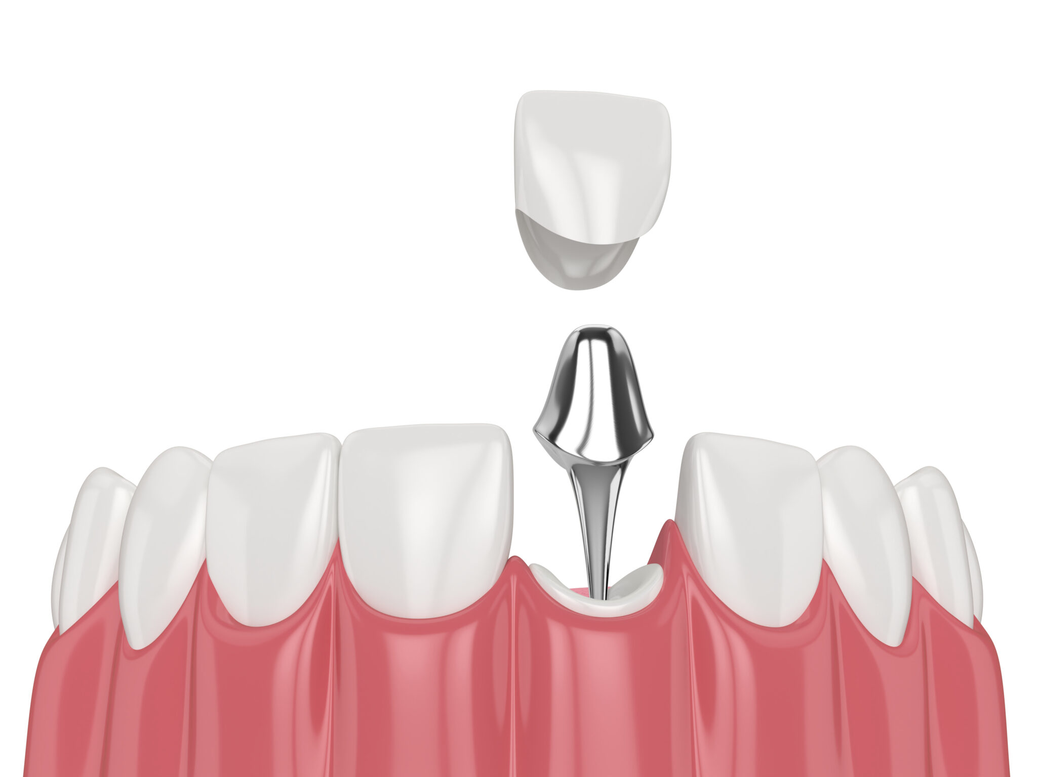 Stabilizing Your Teeth With Post And Core | El Paso, TX